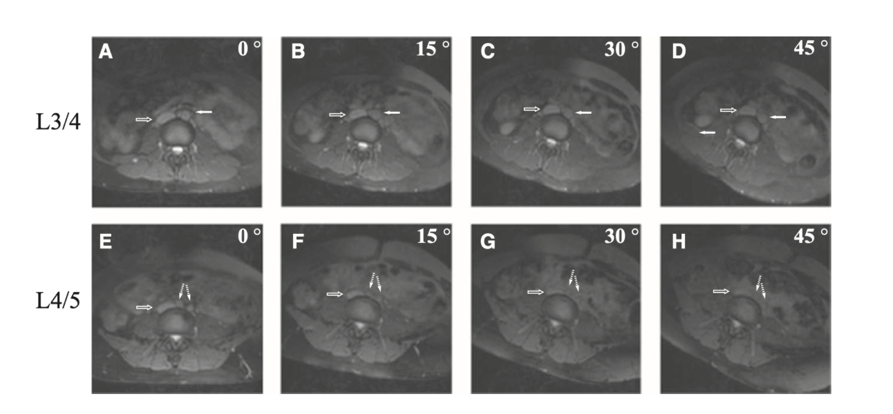 Does Left Lateral Tilt Effectively Treat Supine Hypotensive Syndrome ...
